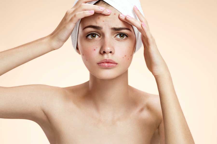 How To Remove Pimples Scars At Home Find Doctor 24 How To Remove Pimples Scars At Home Find Doctor 24